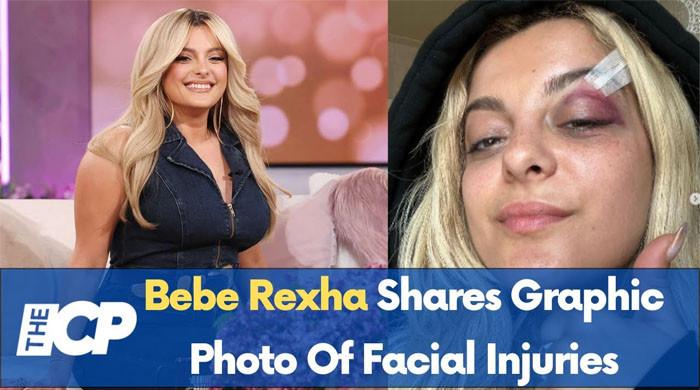 Bebe Rexha Shares Graphic Photo Of Facial Injuries - The Celeb Post